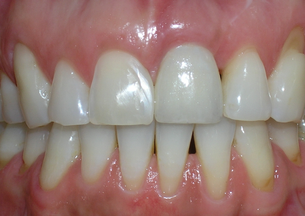 implant-after-lg - Brian Novak, DMD